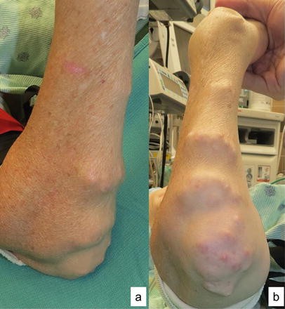 Soft Tissue Management of Elbow Deformities | SpringerLink