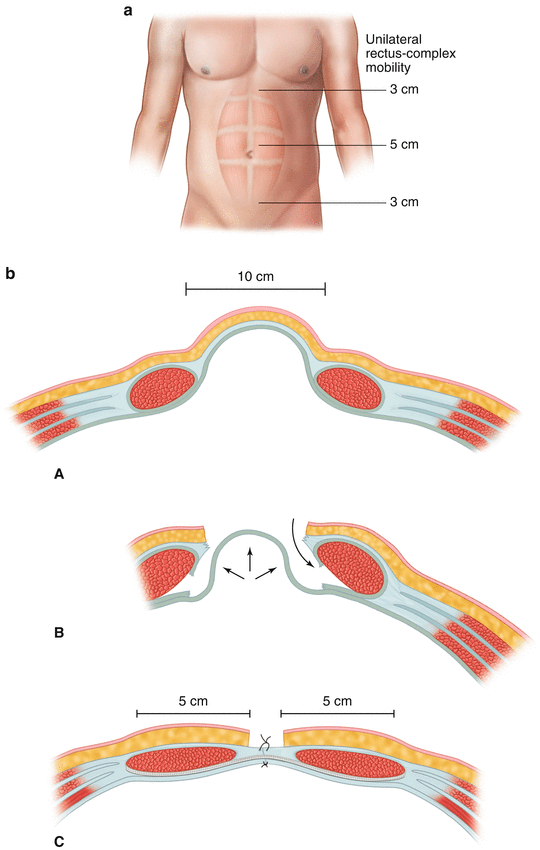 Rives-Stoppa Retromuscular Repair | SpringerLink