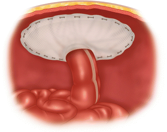 Open Parastomal Hernia Repair | SpringerLink