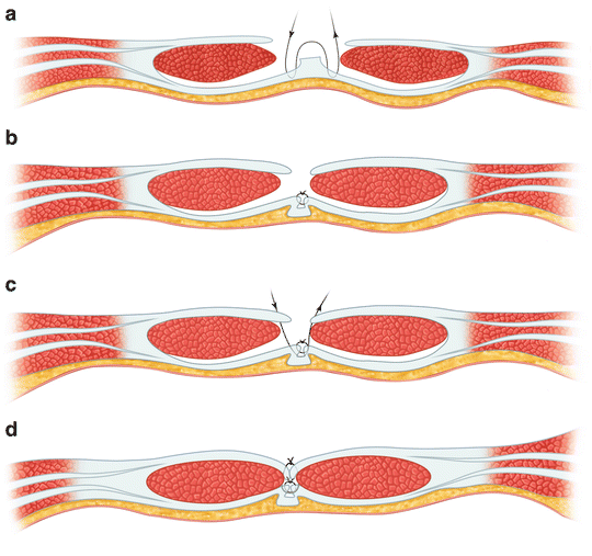 Diagnosis and Management of Diastasis Recti | SpringerLink