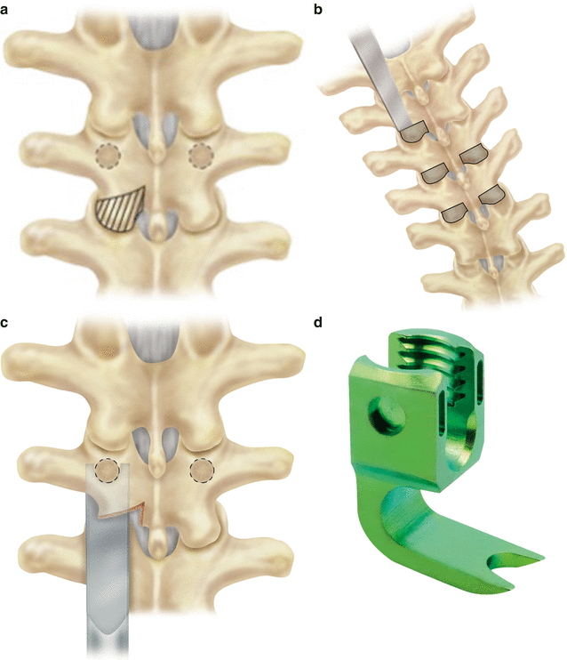 Posterior Thoracolumbar Fixation: Overview of Implants and Surgical ...