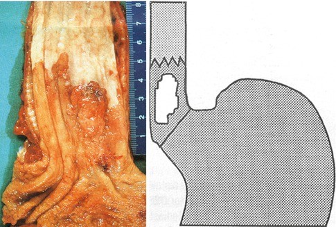 Siewert Classification of Adenocarcinoma of the Esophagogastric ...