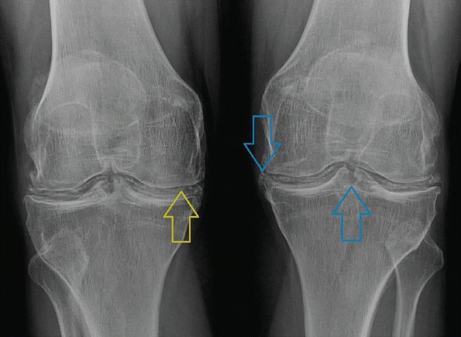 Radiology and Ultrasonography Findings in Chondrocalcinosis | SpringerLink