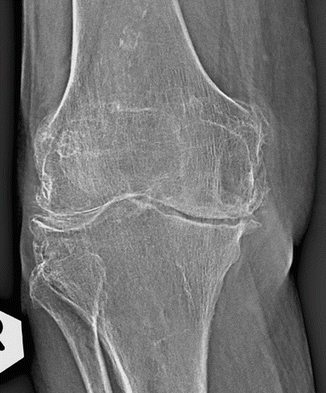 Radiology and Ultrasonography Findings in Chondrocalcinosis | SpringerLink