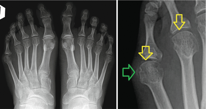 Radiology and Ultrasonography Findings in Chondrocalcinosis | SpringerLink