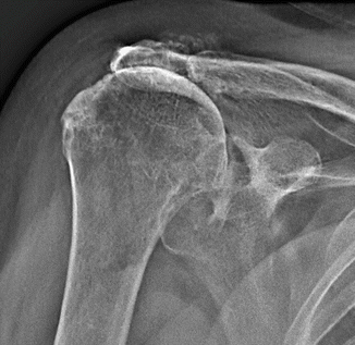 Radiology and Ultrasonography Findings in Chondrocalcinosis | SpringerLink