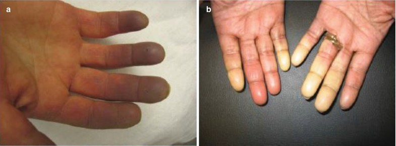 Raynaud’s Phenomenon, Digital Ulcers and Nailfold Capillaroscopy ...
