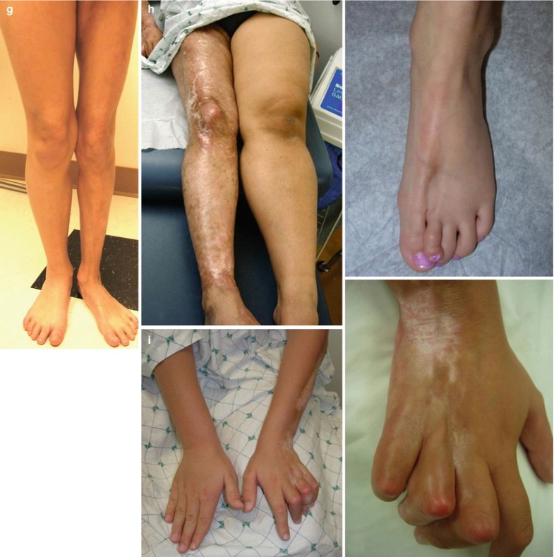 Morphea (Localized Scleroderma) | SpringerLink