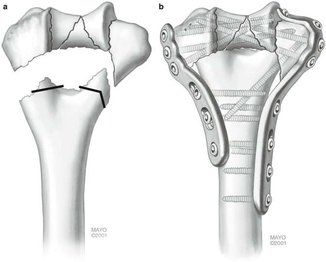 Open Reduction and Internal Fixation for Distal Humerus Fractures and ...