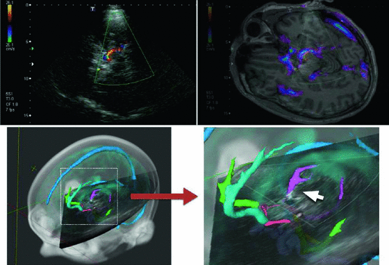 Atlas-Guided Transcranial Doppler Ultrasound Examination with a Neuro ...
