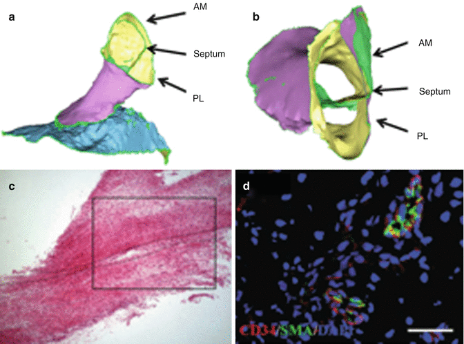 Double-Bundle Anterior Cruciate Ligament Reconstruction | SpringerLink
