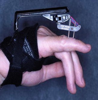 Preliminary Soft-Tissue Distraction with the Digit WidgetTM in the ...