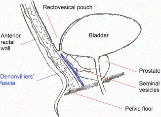 Denonvilliers’ Fascia: Anatomy, Surgical Planes, Use in Reconstruction ...