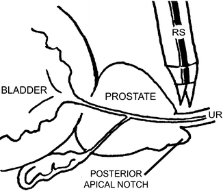 Innovation and Orientation Challenges: Posterior “Retzius-Sparing ...