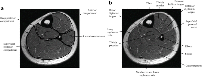Chronic Exertional Compartment Syndrome | SpringerLink