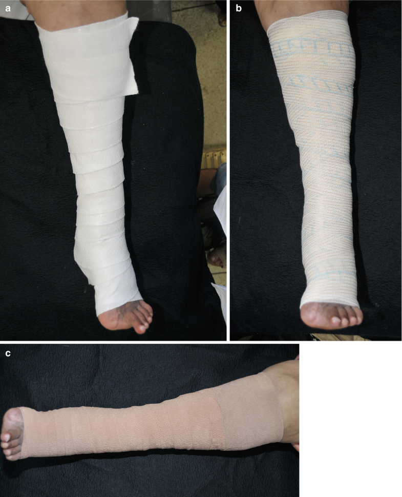 Leg Ulcers and Lymphedema | SpringerLink