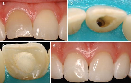 Intracoronal Whitening of Endodontically Treated Teeth | SpringerLink