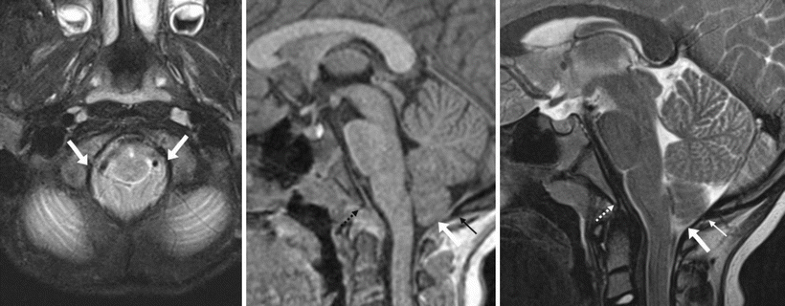 Cerebellar Tonsillar Ectopia | SpringerLink