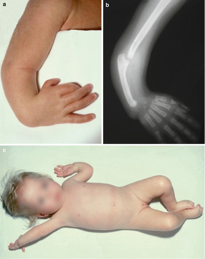 Limb and Back Reduction Deficiency Present at Birth | SpringerLink