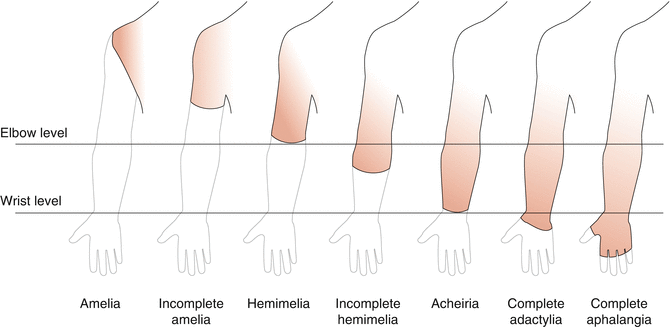 Limb and Back Reduction Deficiency Present at Birth | SpringerLink