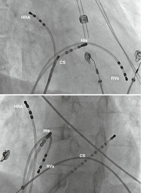 Cardiac Electrophysiology Study, Diagnostic Maneuvers and Ablation ...