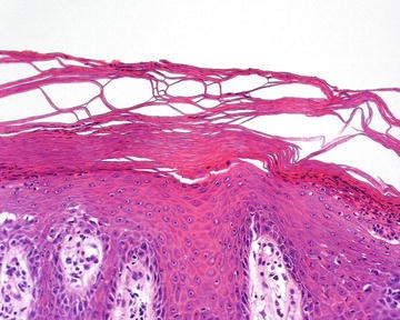 Psoriasiform Dermatitis | SpringerLink