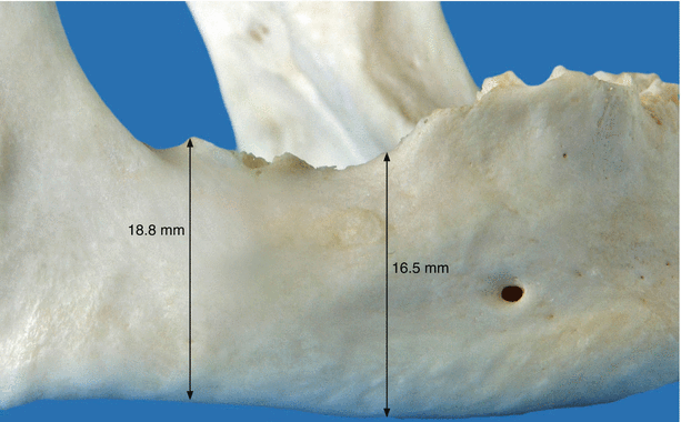 Posterior Mandible | SpringerLink