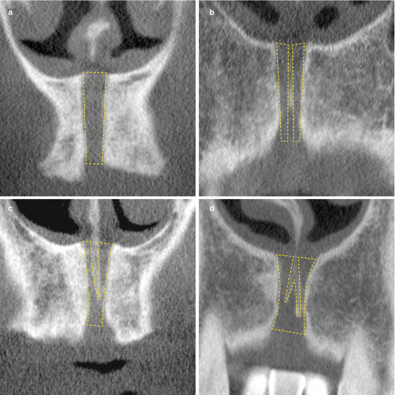 Nasopalatine Canal | SpringerLink
