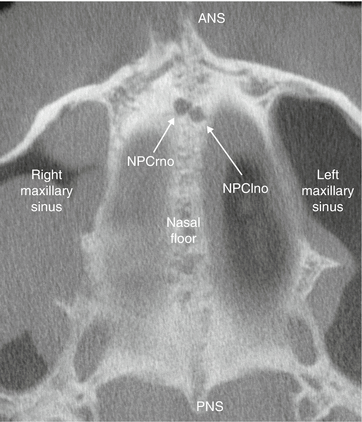 Nasopalatine Canal | SpringerLink