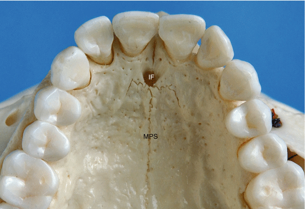 Nasopalatine Canal | SpringerLink