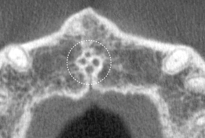 Nasopalatine Canal | SpringerLink