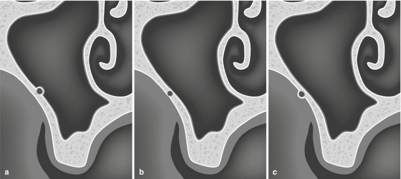 Posterior Maxilla | SpringerLink
