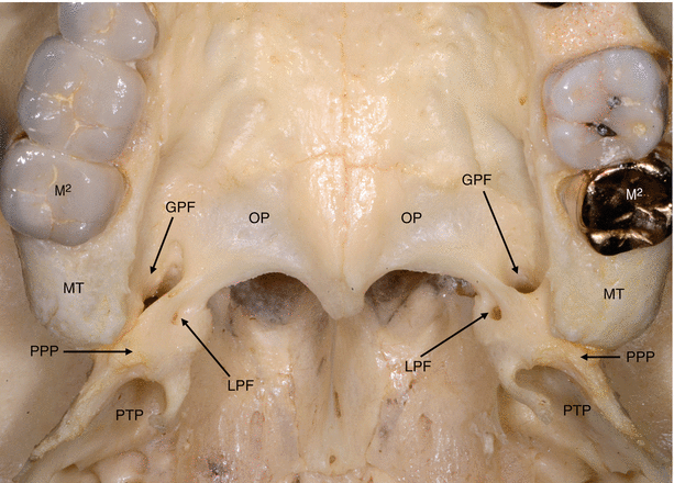 Posterior Maxilla | SpringerLink