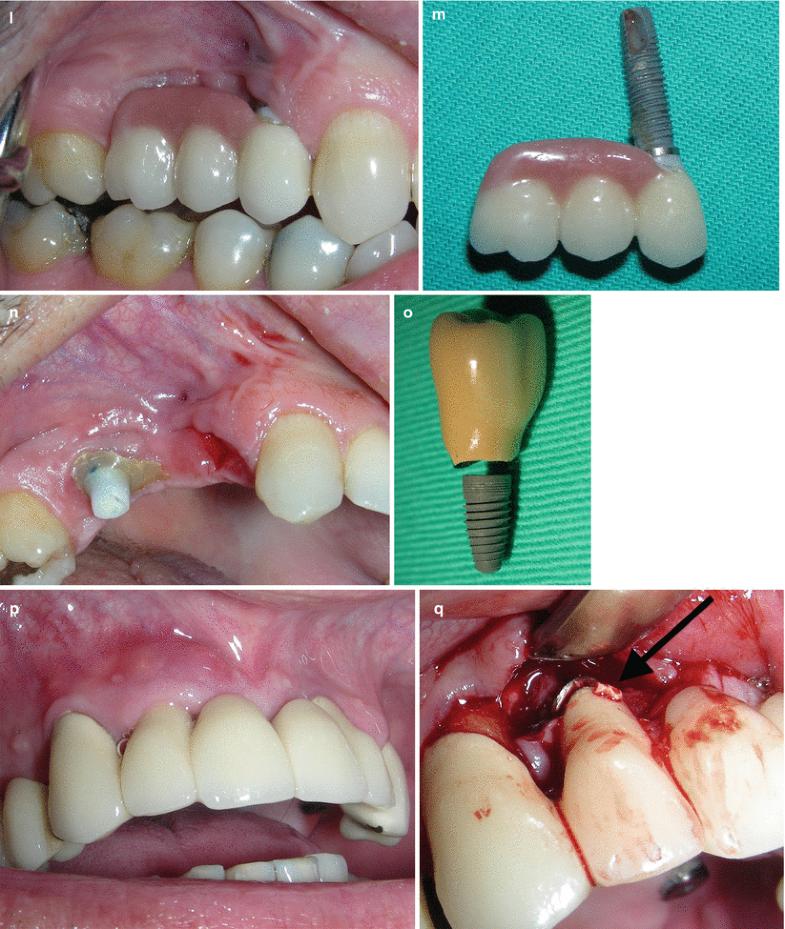 Complications and Failures Related to Implant Dentistry | SpringerLink
