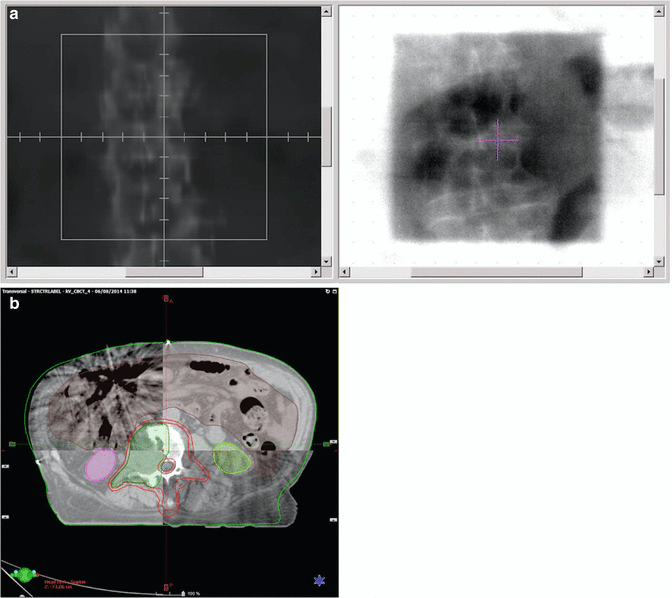 Bone Metastases from Prostate Cancer: Radiotherapy | SpringerLink