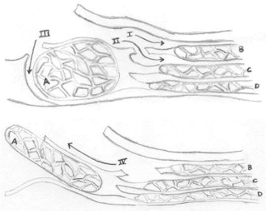 Anterior Component Separation Techniques | SpringerLink