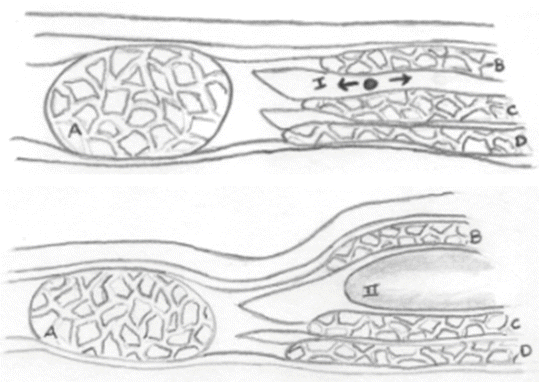 Anterior Component Separation Techniques | SpringerLink