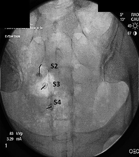 Pudendal Nerve Block | SpringerLink