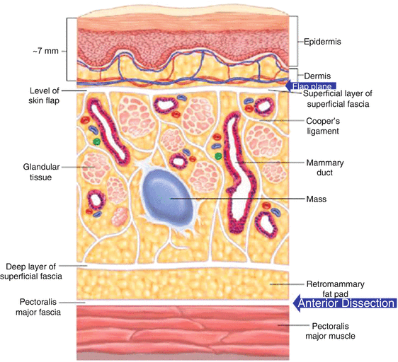 The Vertical Infra-Areolar Approach to Nipple Skin-Sparing or Total ...