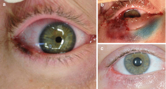 Management of Eyelid Lentigo Maligna | SpringerLink