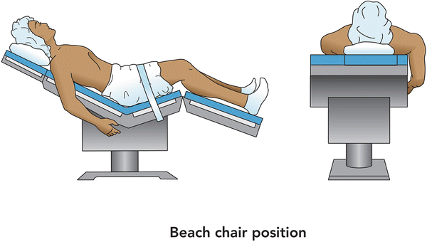 Preventing Perioperative Positioning and Equipment Injuries | SpringerLink