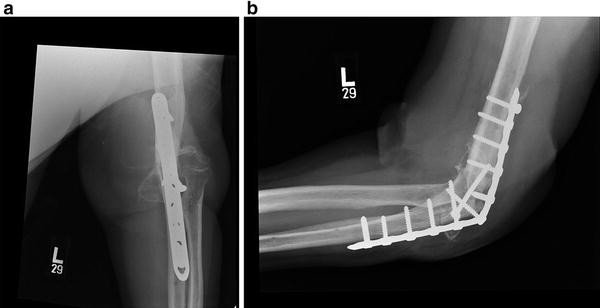 Elbow Fusion for The Unstable Elbow | SpringerLink