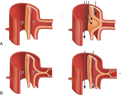 Aortic Dissection | SpringerLink