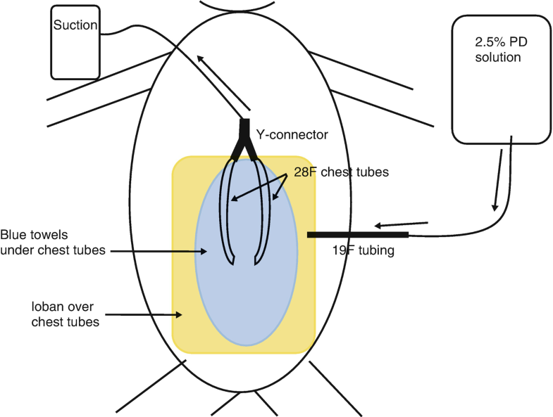 The Role of Instillation in Open Abdomen Management | SpringerLink