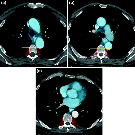 Radiologic Features of Mediastinal Lesions | SpringerLink