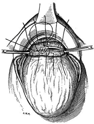 Cesarean Section: The Evidence-Based Technique, Complications, and ...