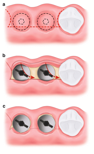 Flap Design, Suturing, and Healing | SpringerLink