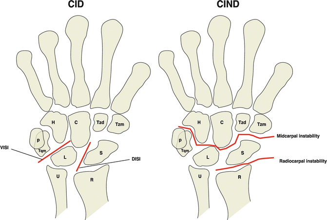 Carpal Instability | SpringerLink
