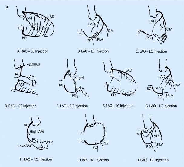 Coronary Collateral Circulation | SpringerLink