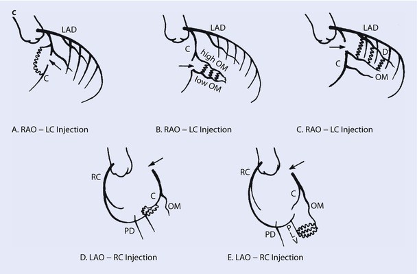 Coronary Collateral Circulation | SpringerLink
